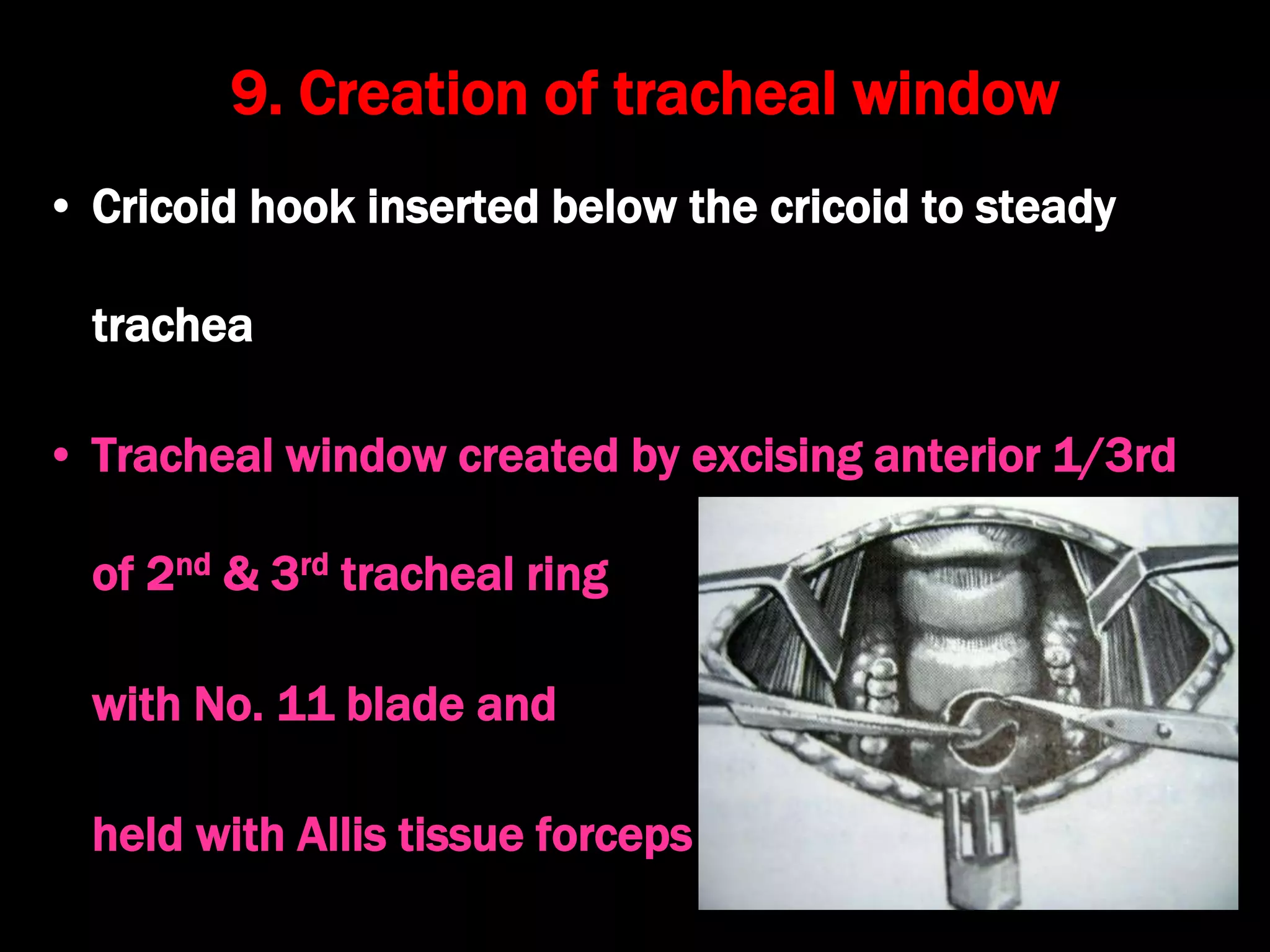 Tracheostomy: History, definition, indications, procedure ...