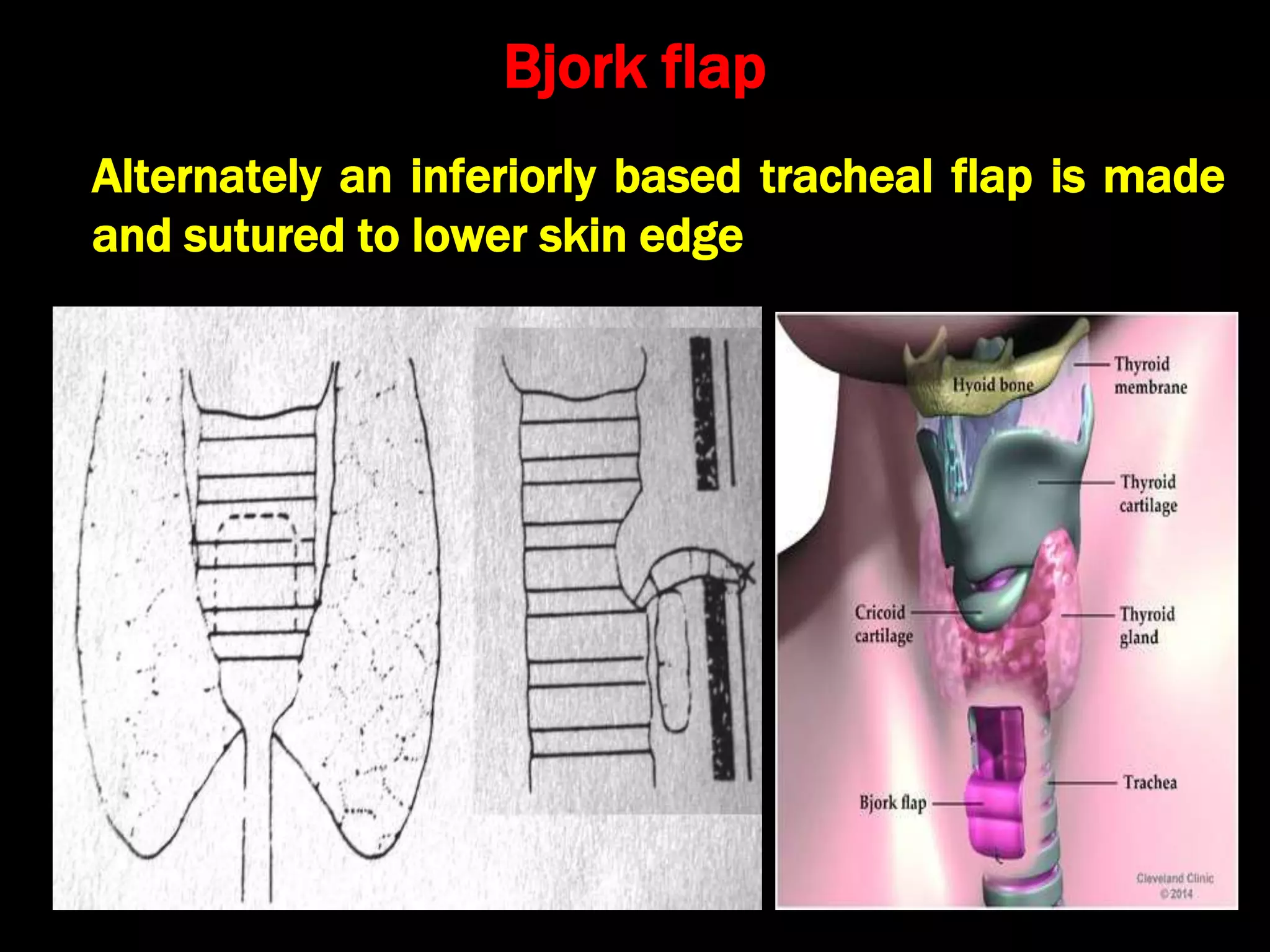 Tracheostomy: History, definition, indications, procedure ...
