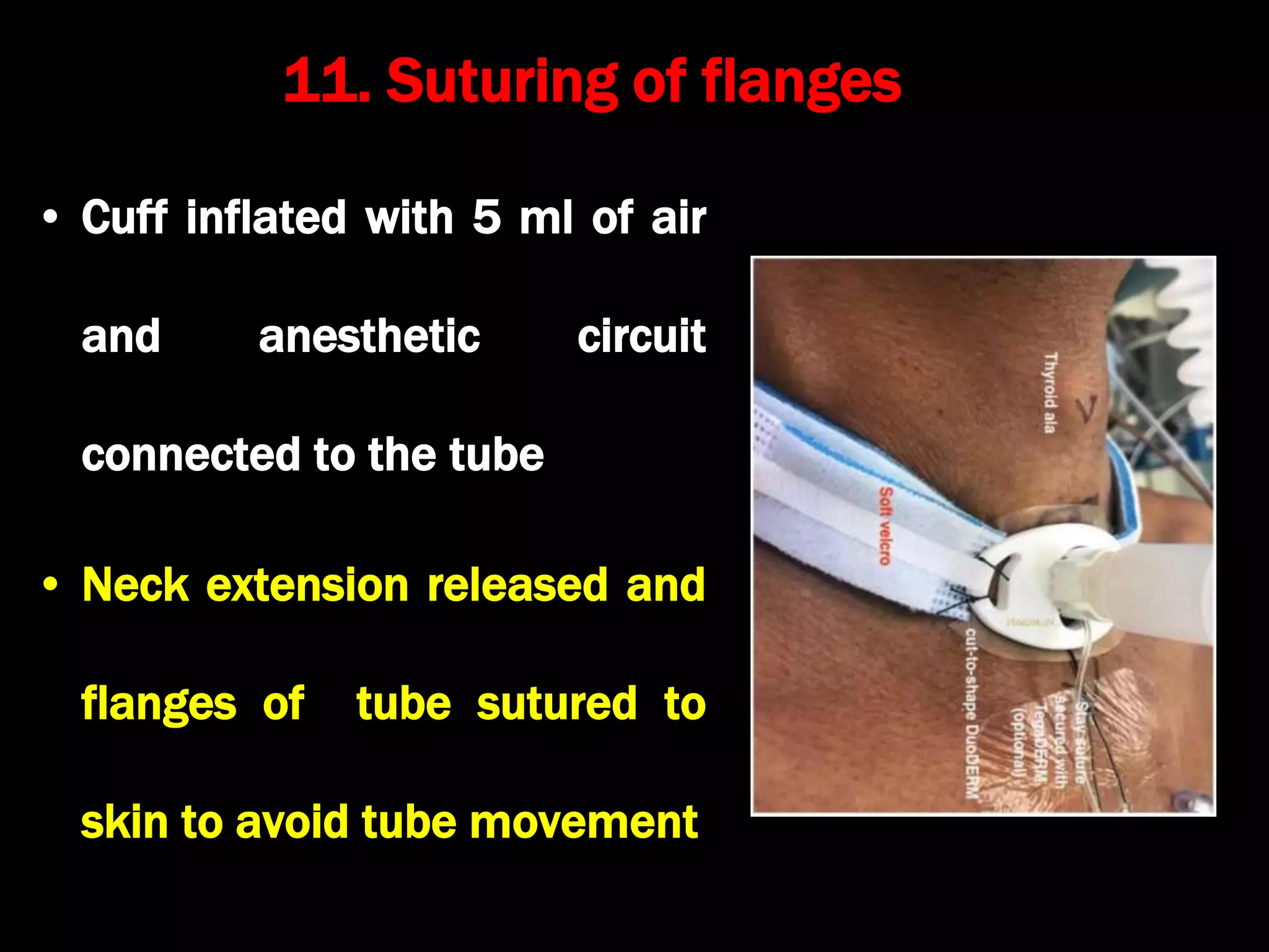 Tracheostomy: History, definition, indications, procedure ...
