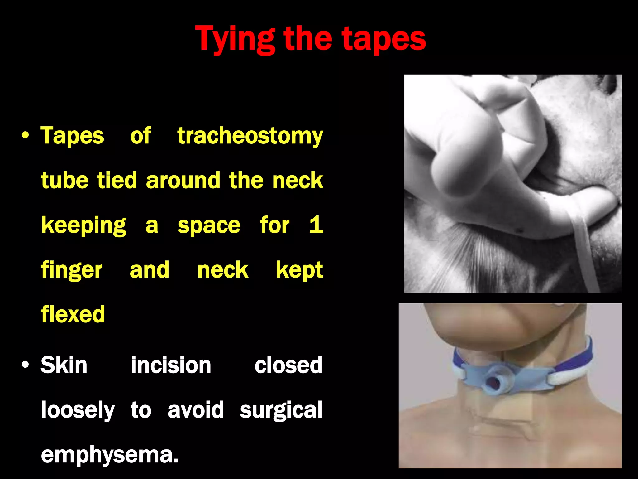 Tracheostomy: History, definition, indications, procedure ...