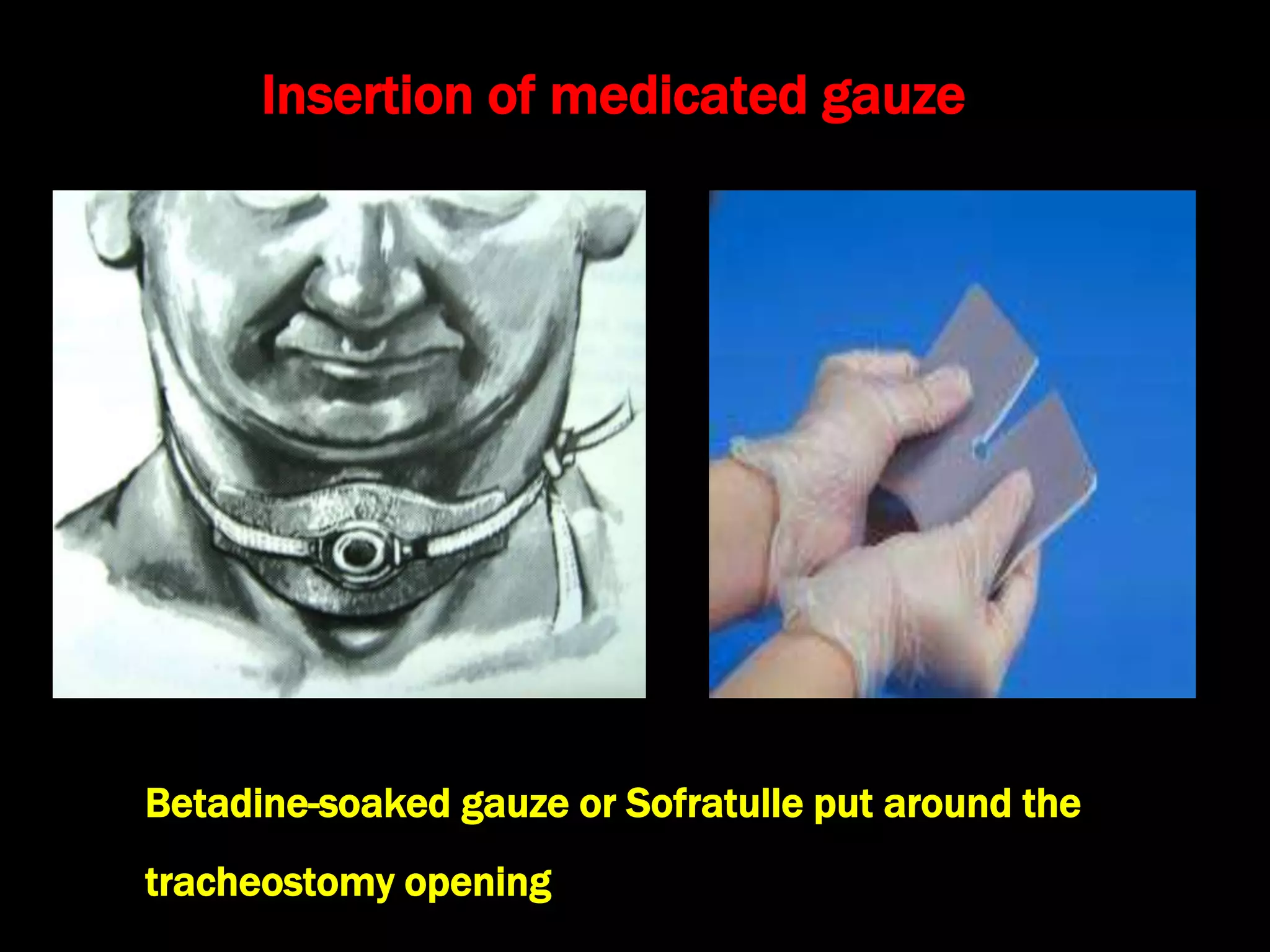 Tracheostomy: History, definition, indications, procedure ...