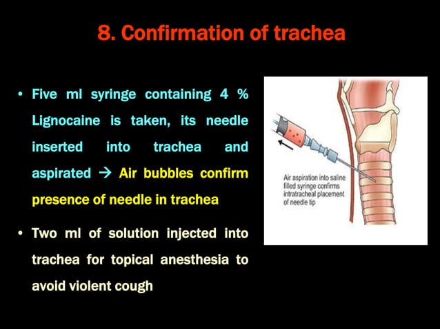 Tracheostomy: History, definition, indications, procedure ...