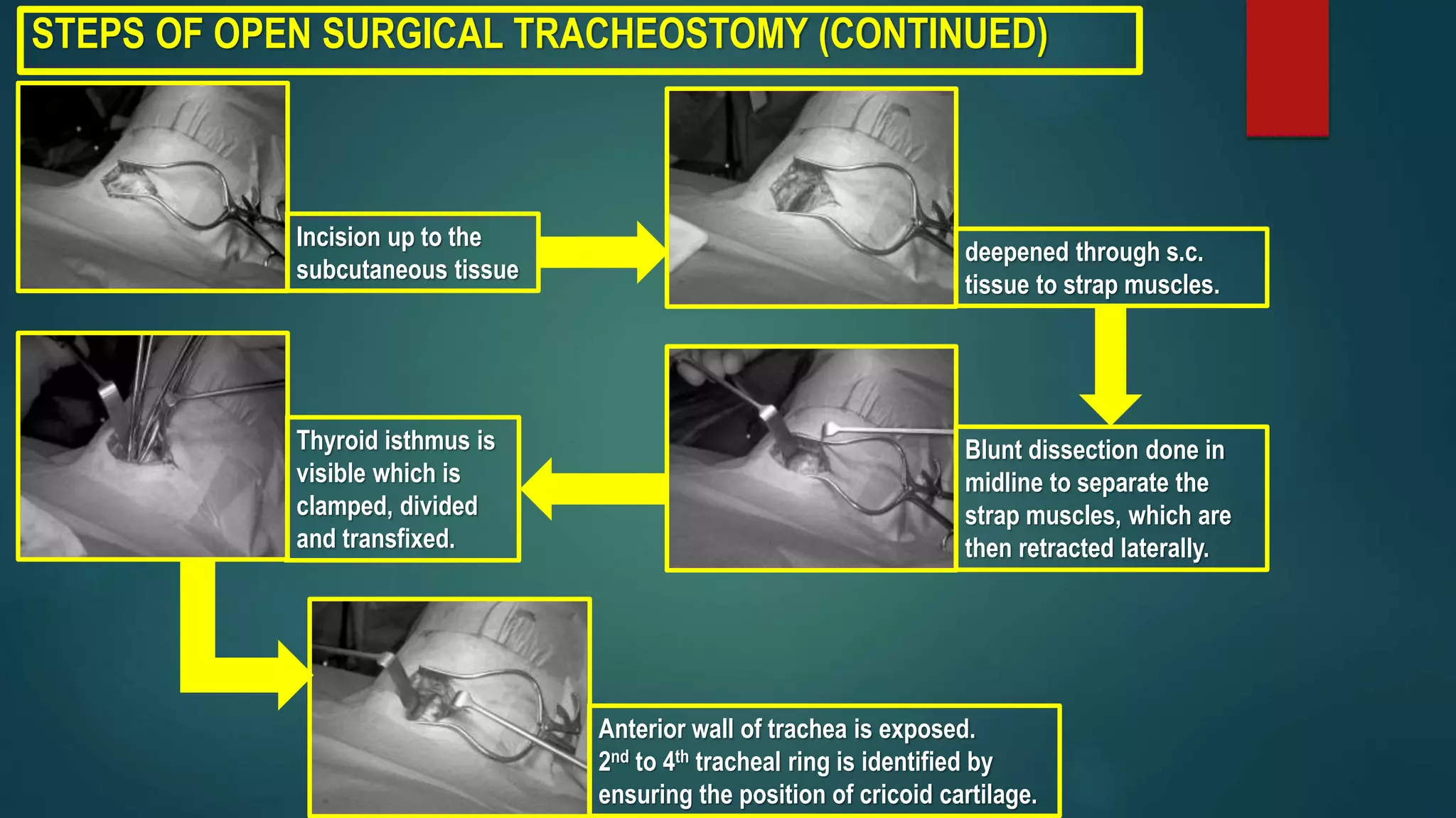 Tracheostomy | PPTX