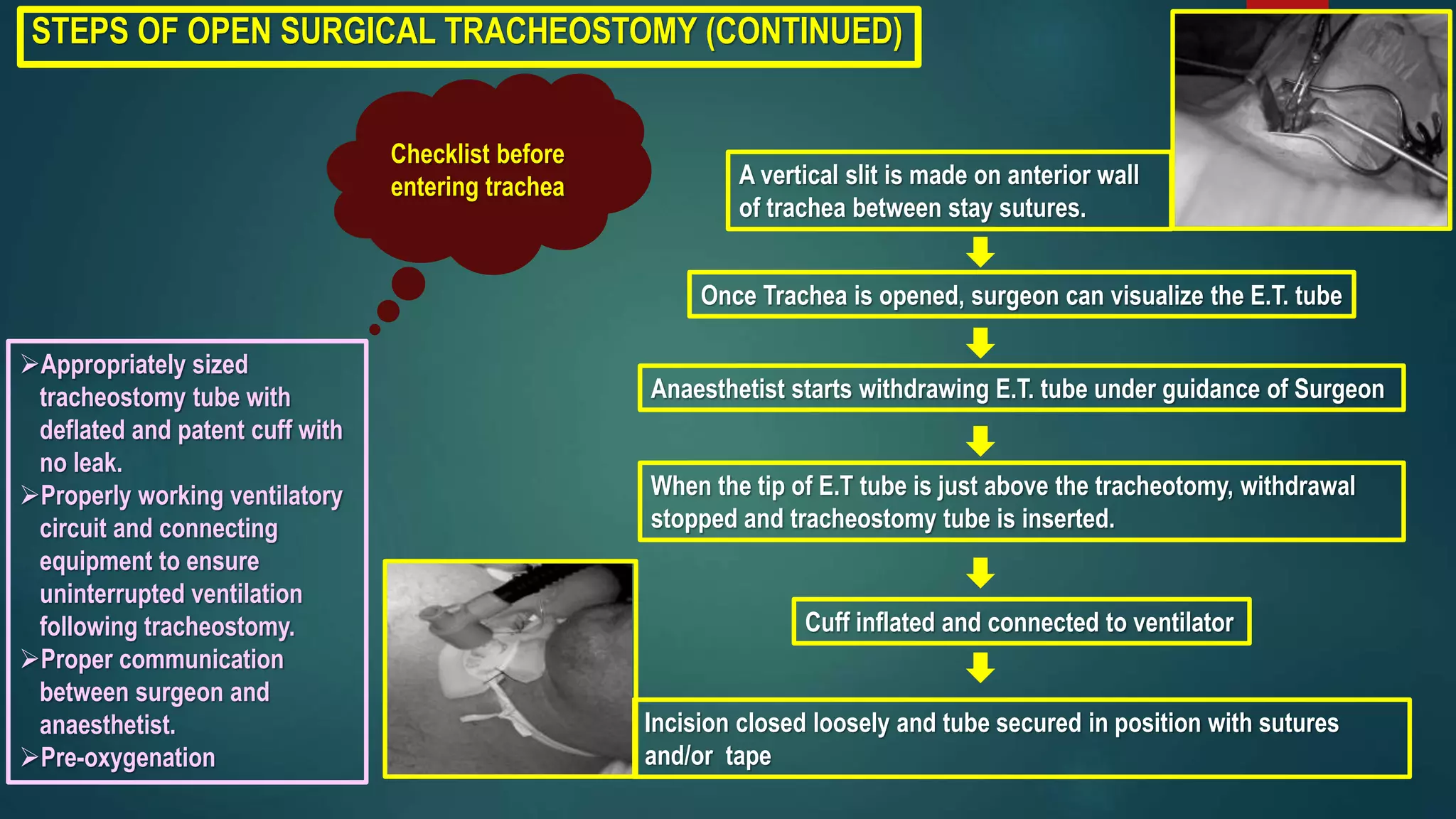 Tracheostomy | PPTX