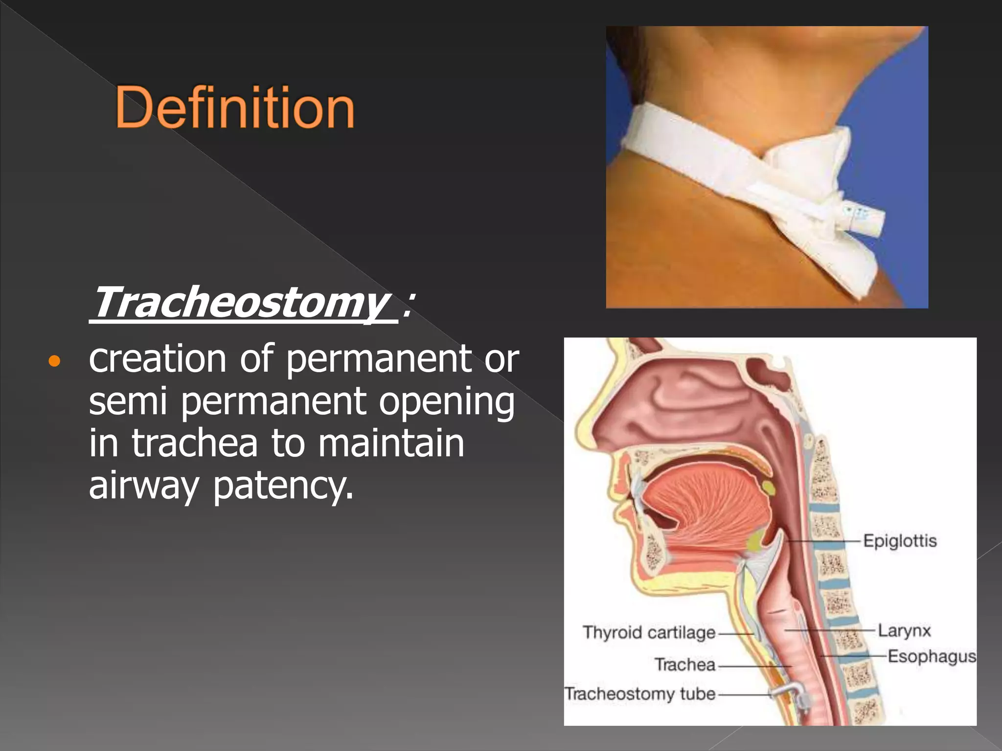 tracheostomy.pptx
