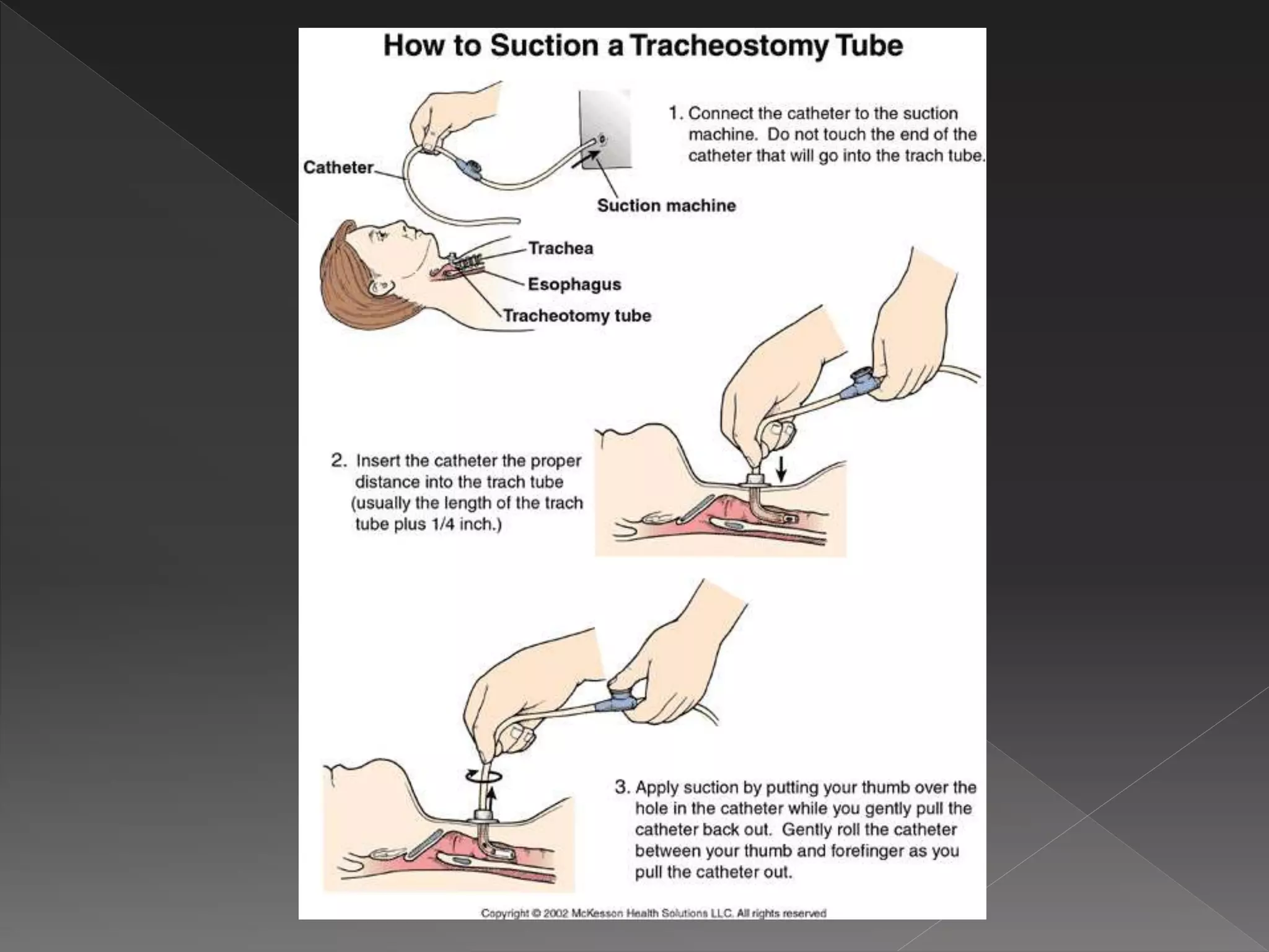 tracheostomy.pptx