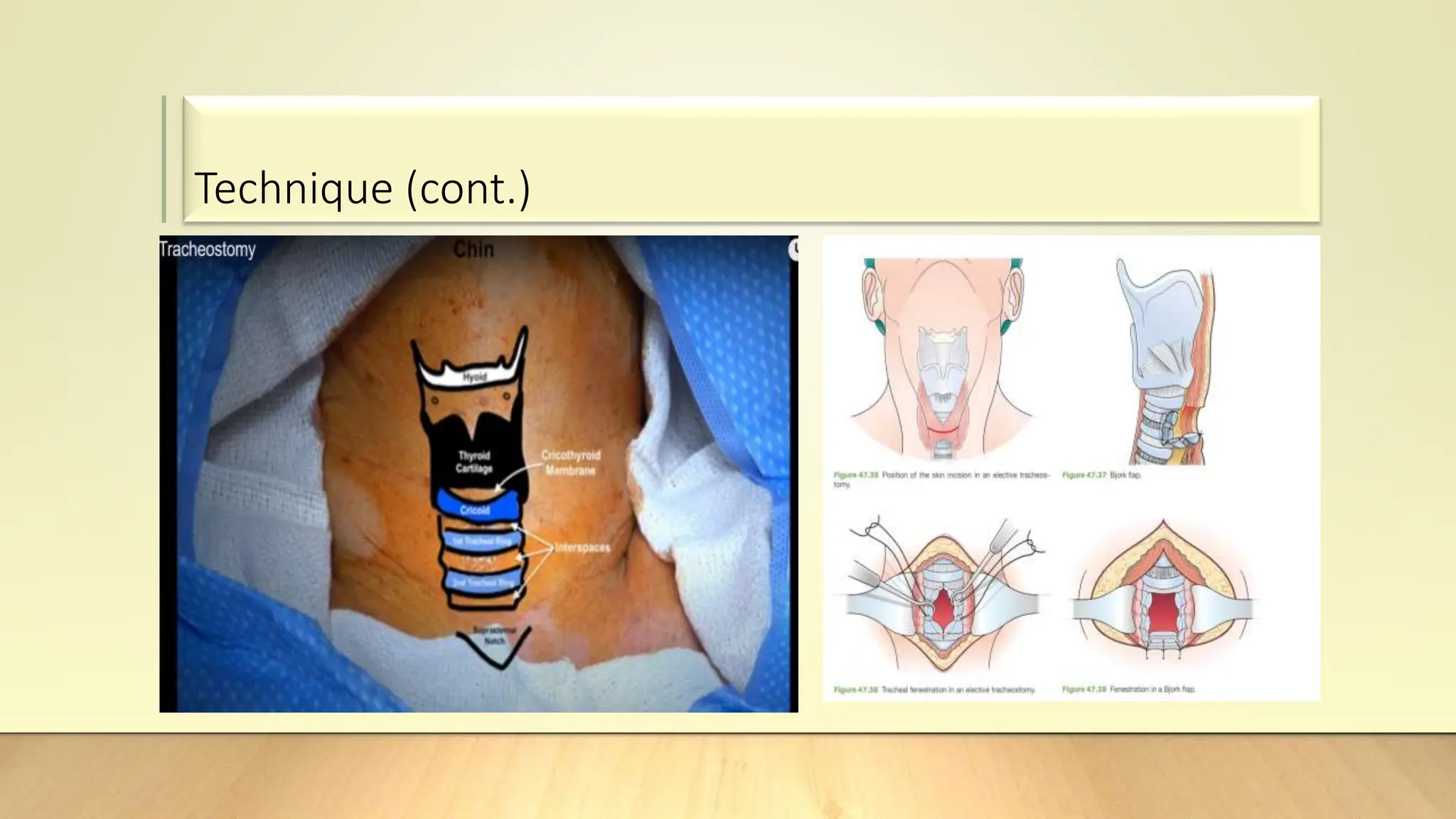 Tracheostomy procedure with indications.pptx