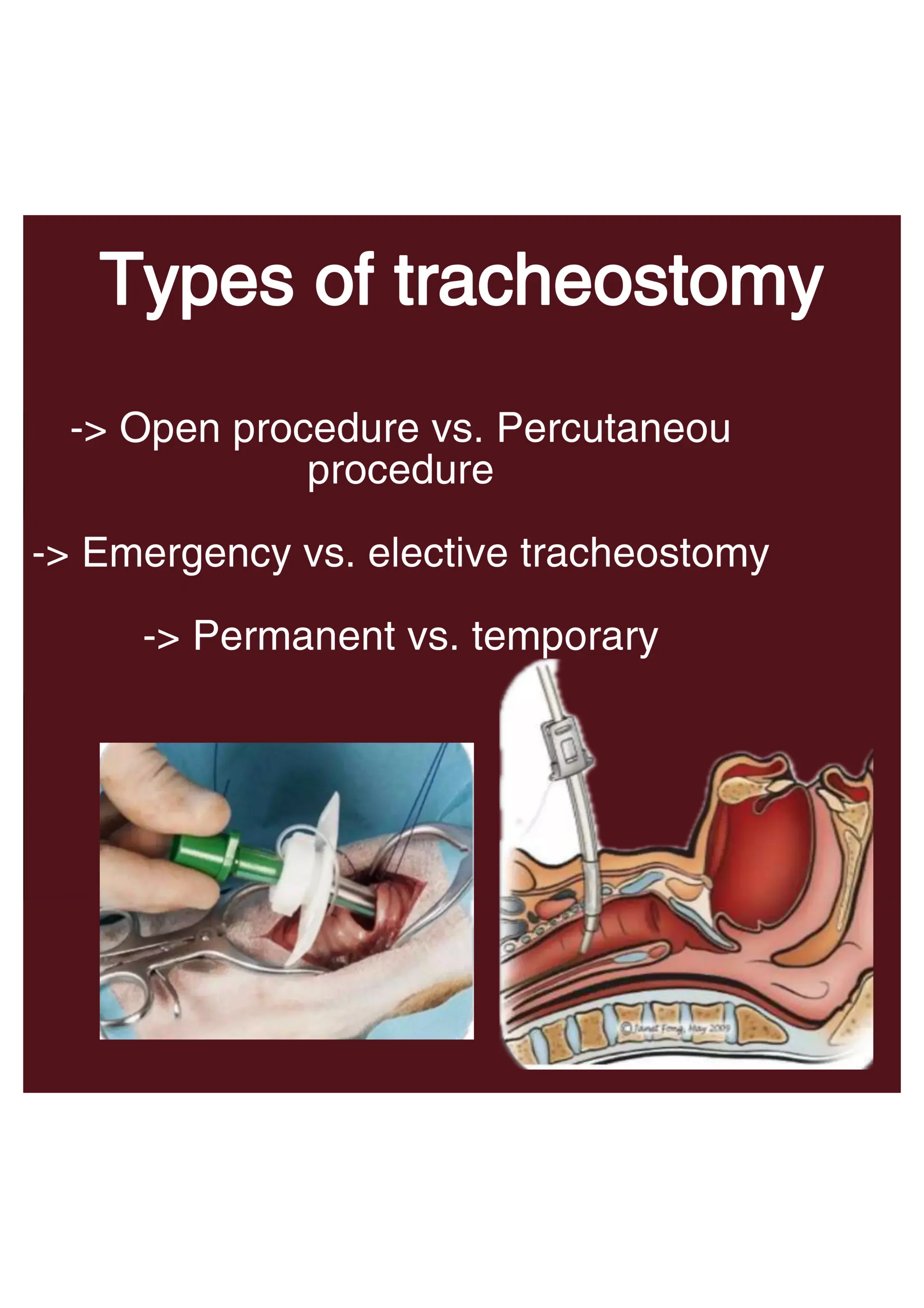 Tracheostomy .pdf ENT by QuickMedTALK. getting things done on time | PDF