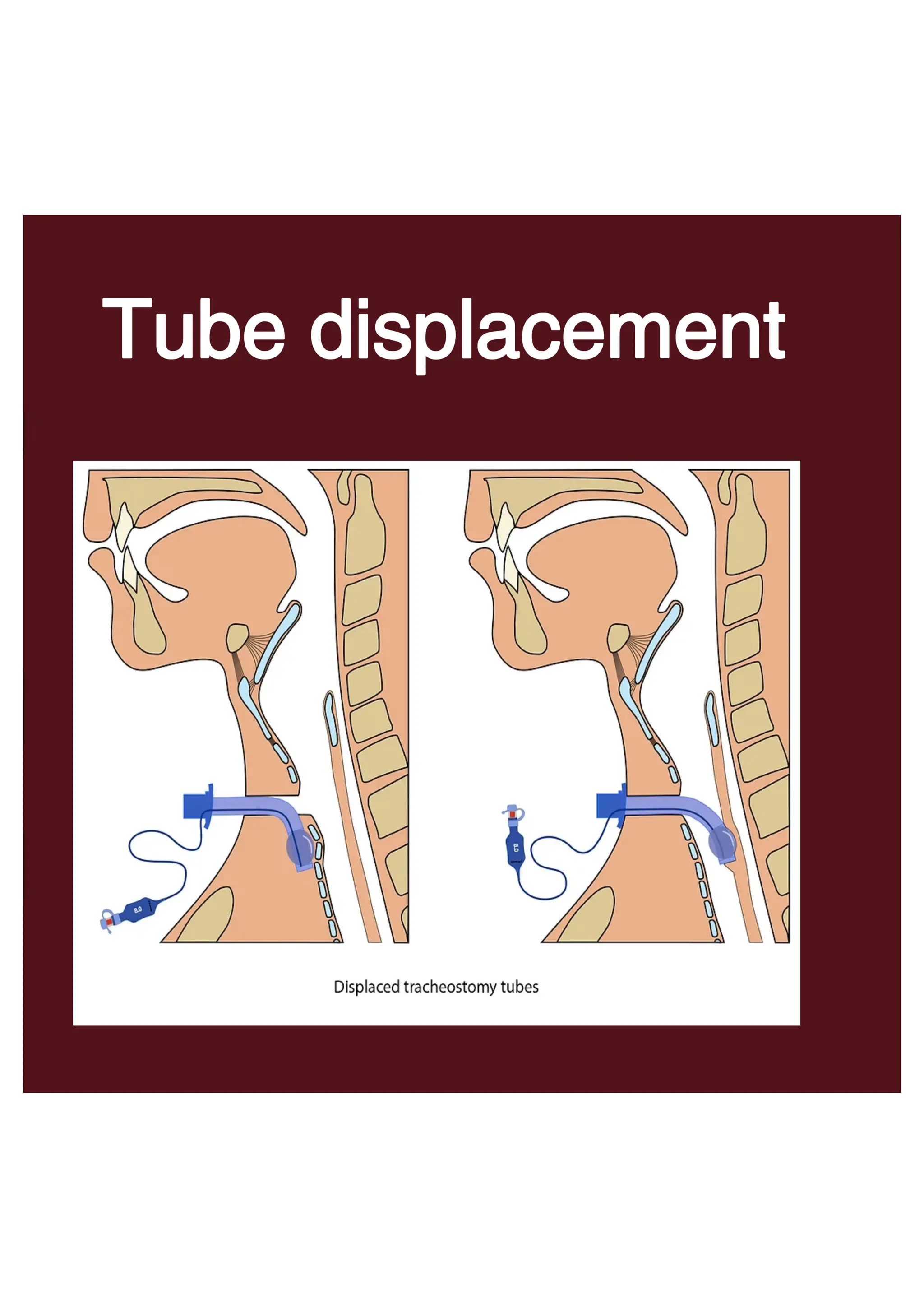 Tracheostomy .pdf ENT by QuickMedTALK. getting things done on time | PDF