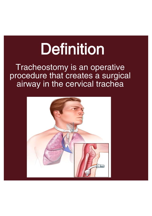 Tracheostomy .pdf ENT by QuickMedTALK. getting things done on time | PDF