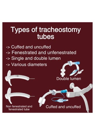 Tracheostomy .pdf ENT by QuickMedTALK. getting things done on time | PDF