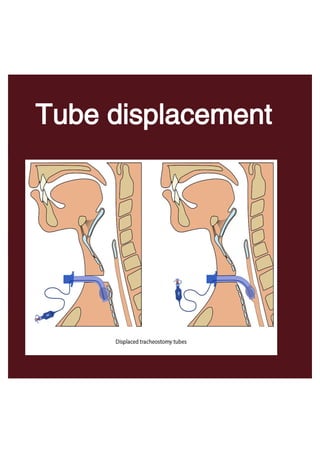 Tracheostomy .pdf ENT by QuickMedTALK. getting things done on time | PDF