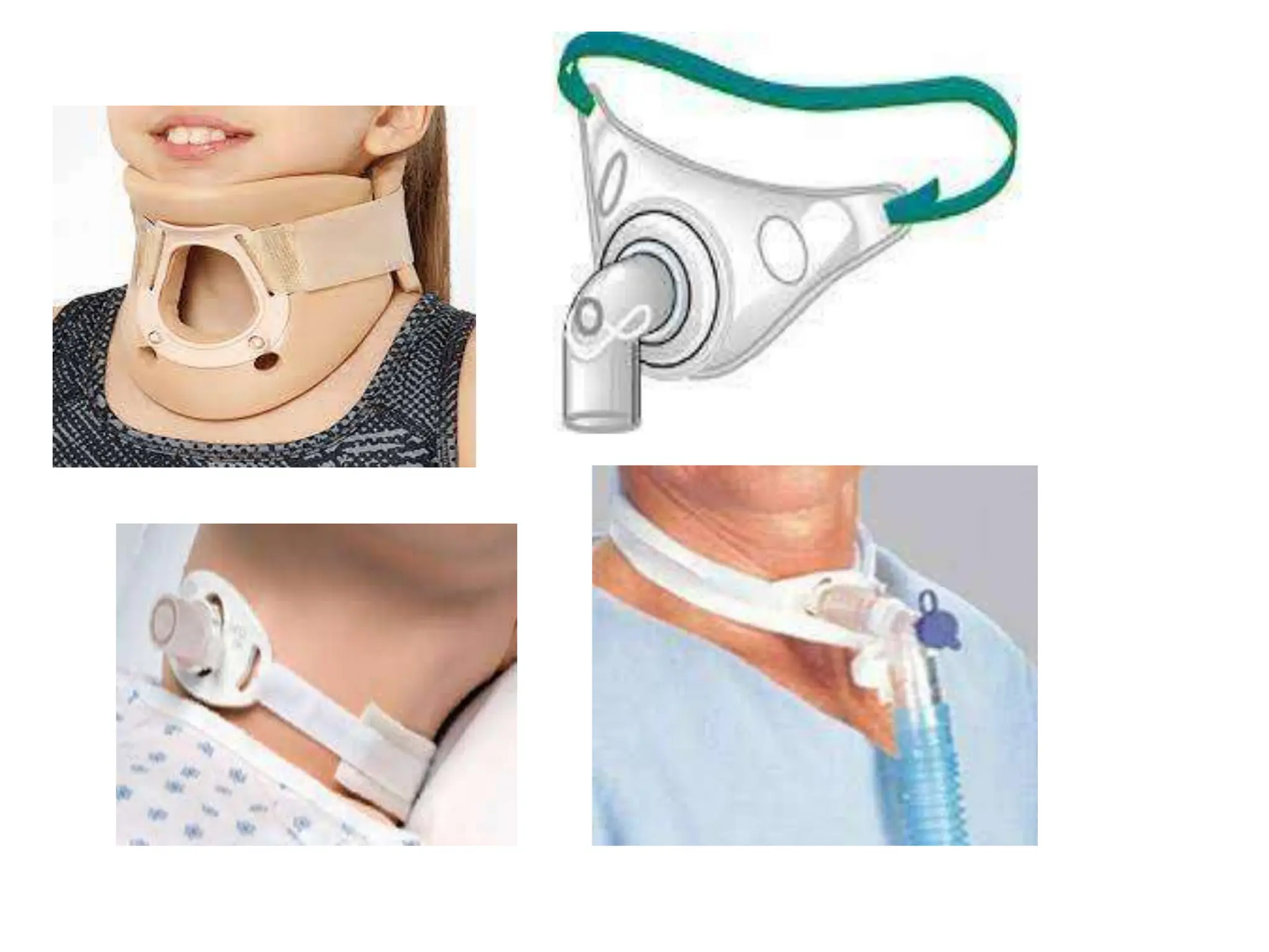 tracheostomy.pptx,....................... | PPTX