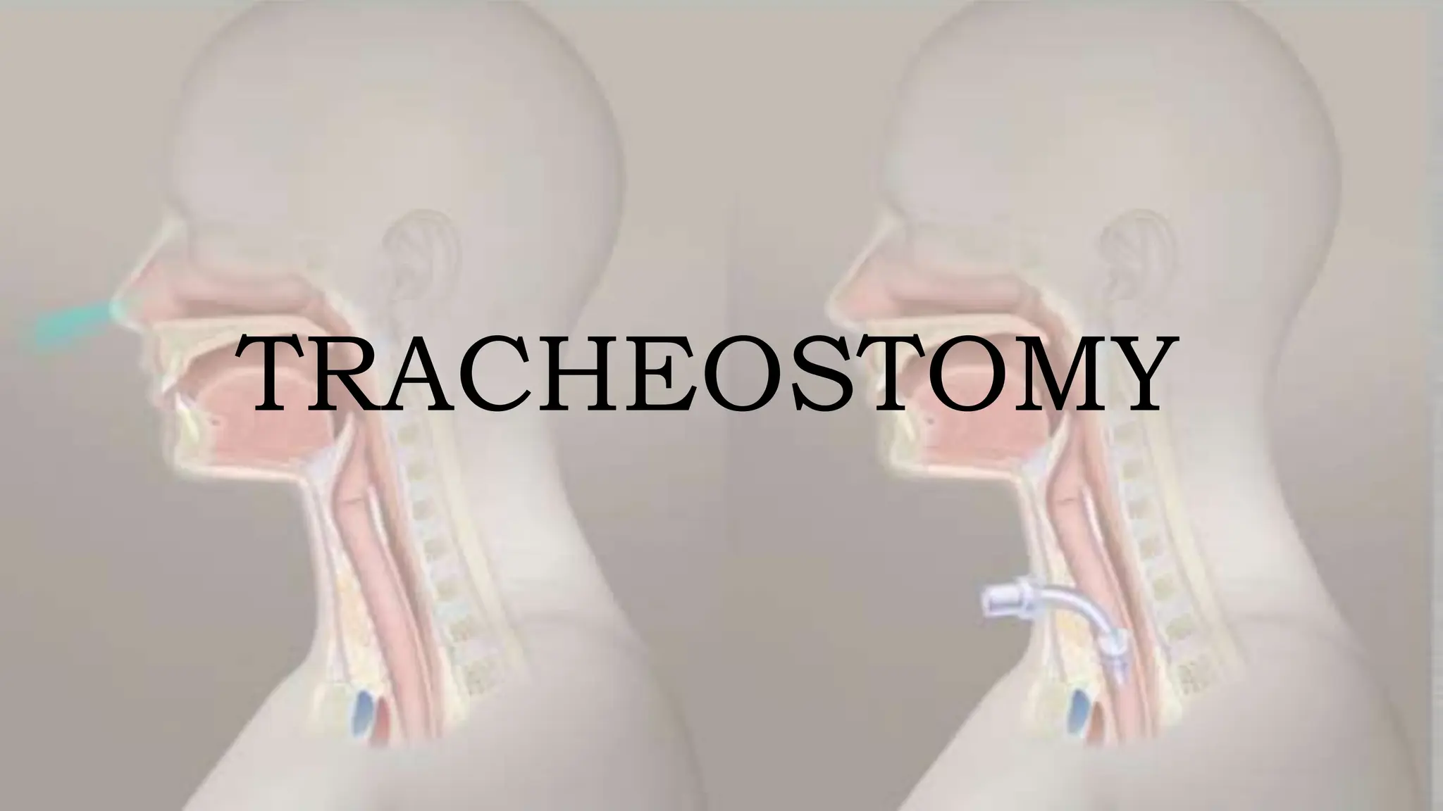 "Tracheostomy" Seminar for oral and maxillofacial surgery postgraduates ...
