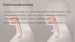 "Tracheostomy" Seminar for oral and maxillofacial surgery postgraduates ...