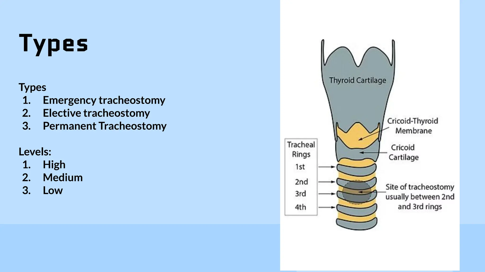 Tracheostomy The basics, introduction, indications and complications | PDF