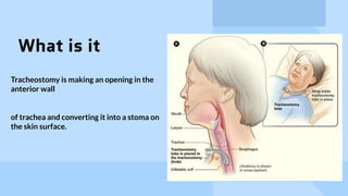 Tracheostomy The basics, introduction, indications and complications | PDF