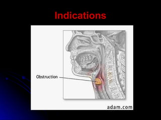 Tracheostomy ent indication and complications.ppt