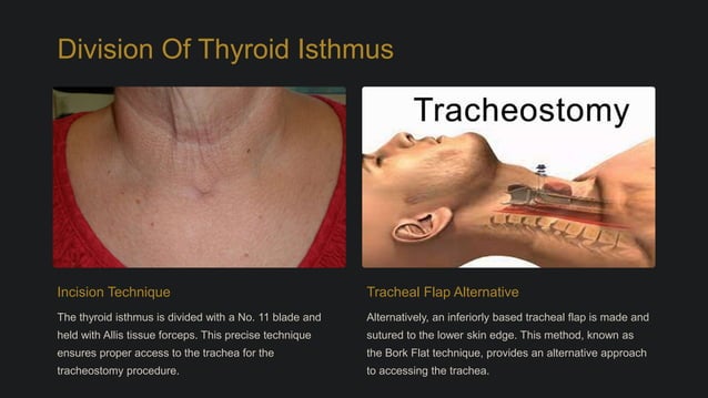 Tracheostomy-A-LIFESAVING Surgical-Airway .pptx