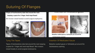 Tracheostomy-A-LIFESAVING Surgical-Airway .pptx