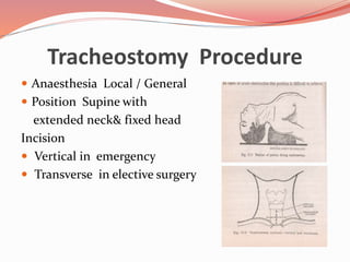 Tracheostomy ashly | PPTX