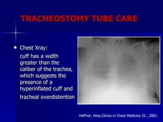 Tracheostomy | PPT
