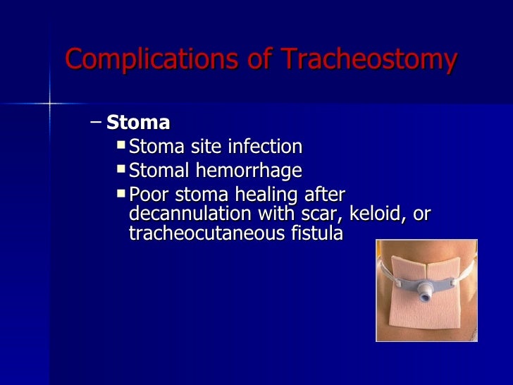 Tracheostomy