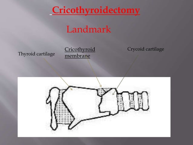 Tracheostomy -INDICATIONS,CONTRAINDICATIONS,PROCEDURE,COMPLICATIONS ...