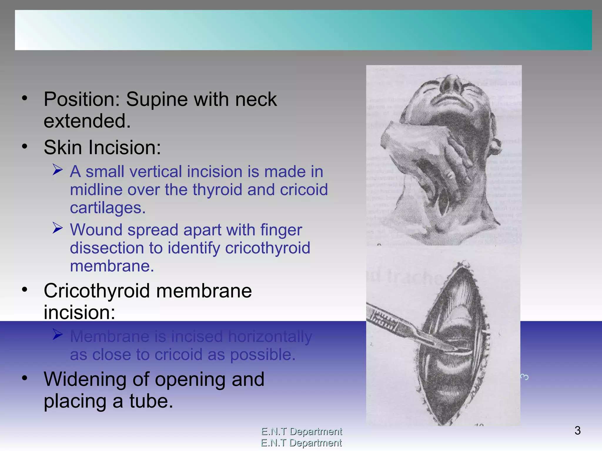 Tracheostomy surgical procedure | PPT