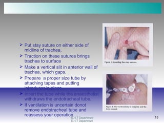 Tracheostomy surgical procedure | PPT