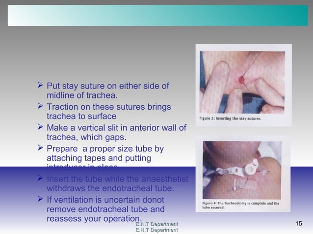 Tracheostomy surgical procedure | PPT