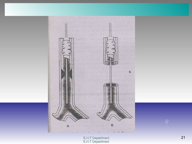 Tracheostomy surgical procedure | PPT
