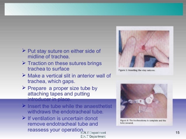 Tracheostomy surgical procedure