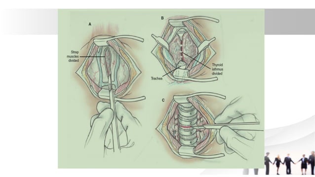 TRACHEOSTOMY, a surgical procedure to exteriorise the windpipe.pptx