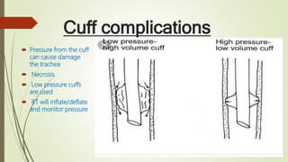 Tracheostomy care. | PPTX
