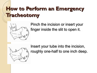 Emergency Tracheotomy