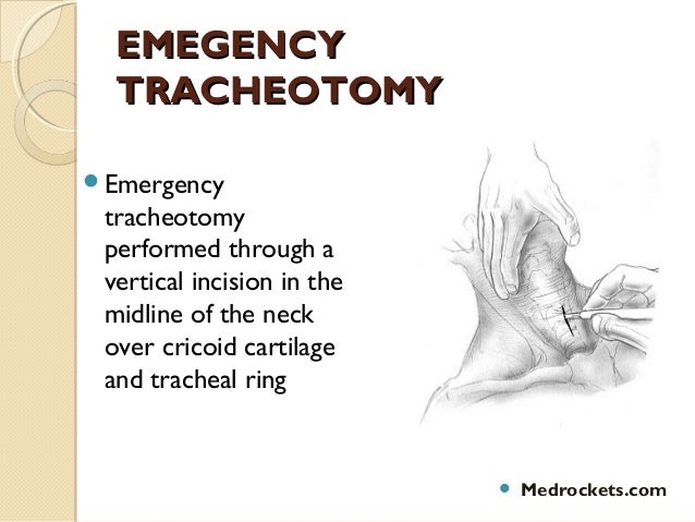Tracheostomy What To Do In An Emergency