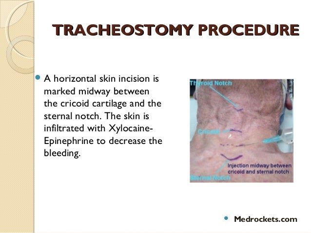 Tracheostomy a