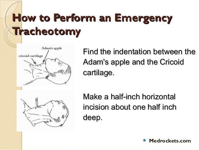 Tracheostomy a