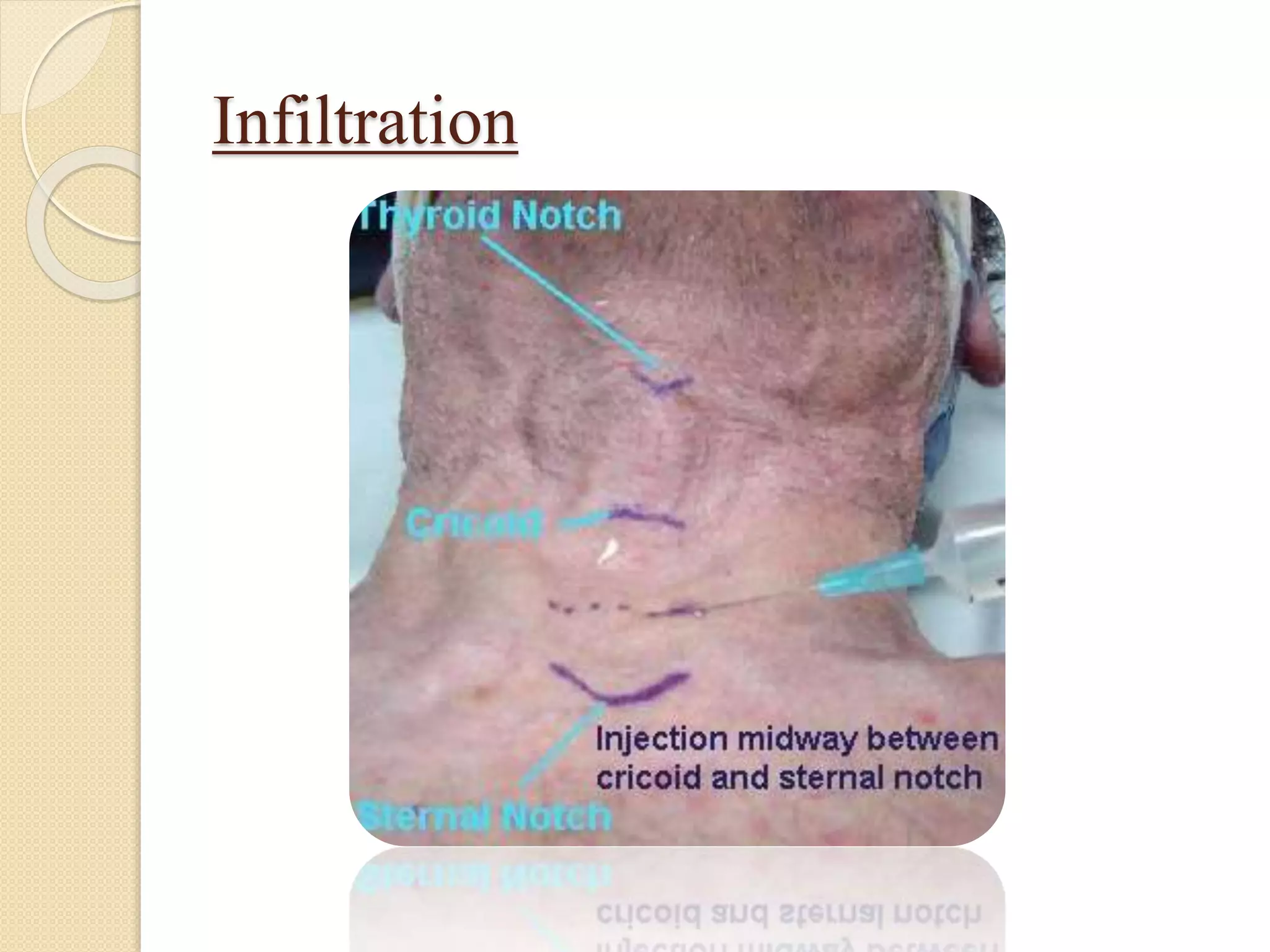 Tracheostomy and its care by Dr.Ashwin menon | PPT