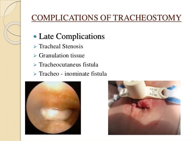 Tracheostomy and its care by Dr.Ashwin menon
