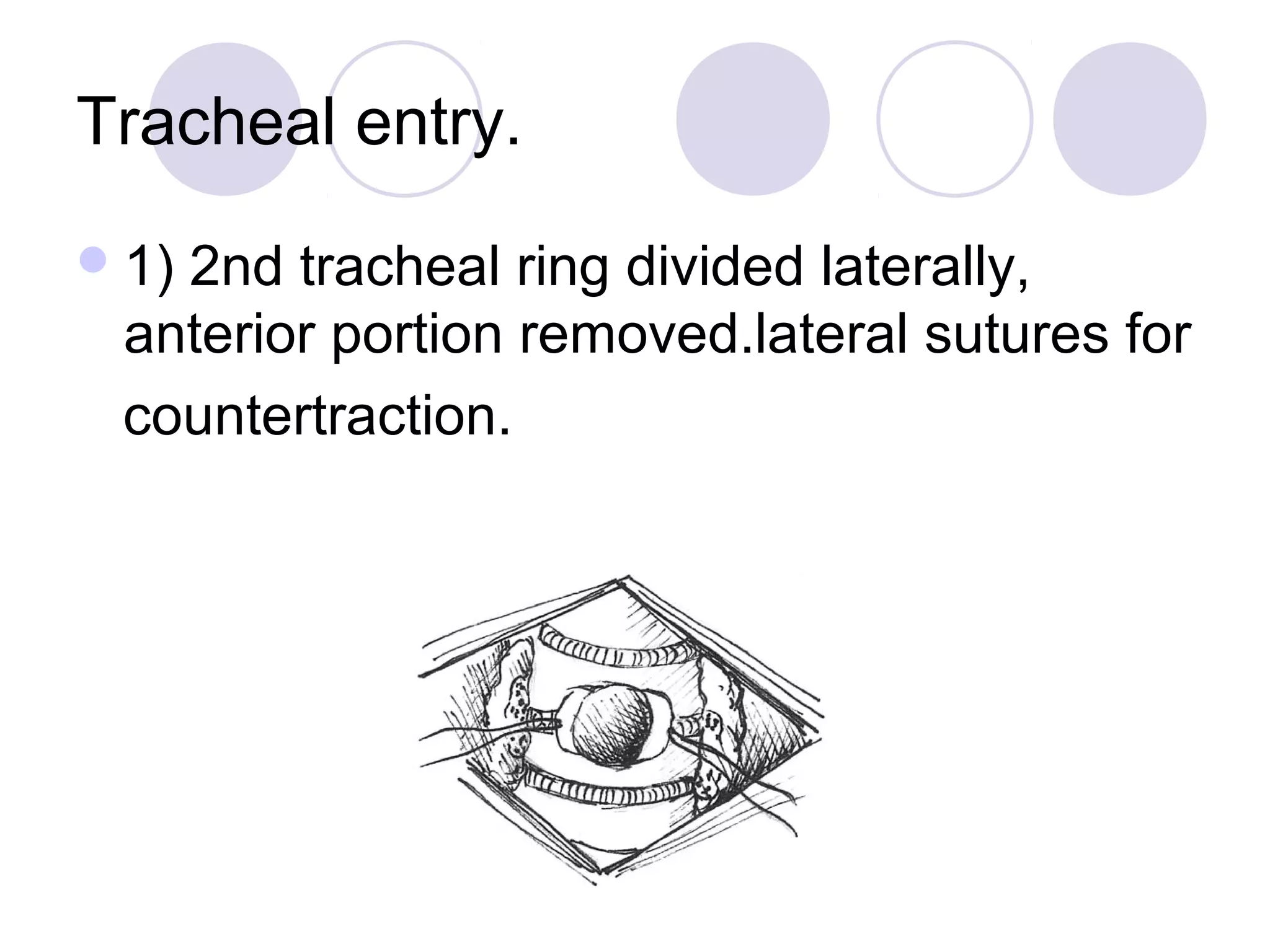 Tracheostomy and its post op care last | PPT