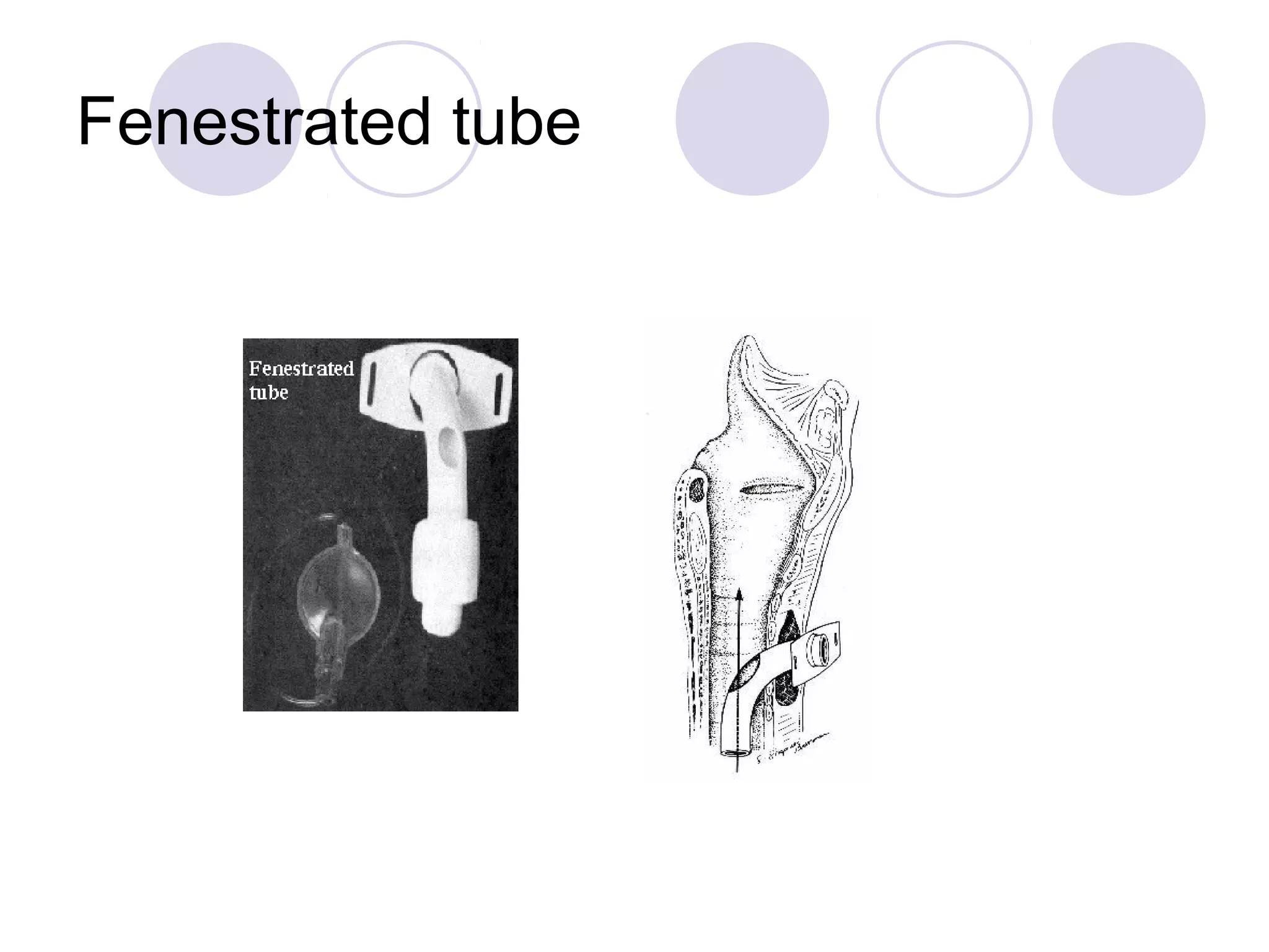 Tracheostomy and its post op care last | PPT