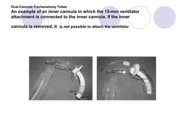 Tracheostomy and its post op care last | PPT | Ear, Nose and Throat ...