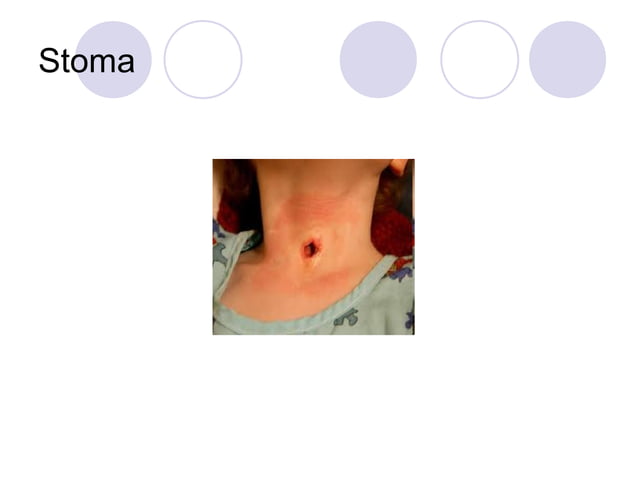 Tracheostomy and its post op care last | PPT | Ear, Nose and Throat ...