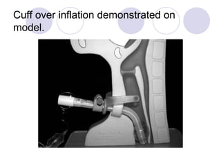Tracheostomy and its post op care last | PPT
