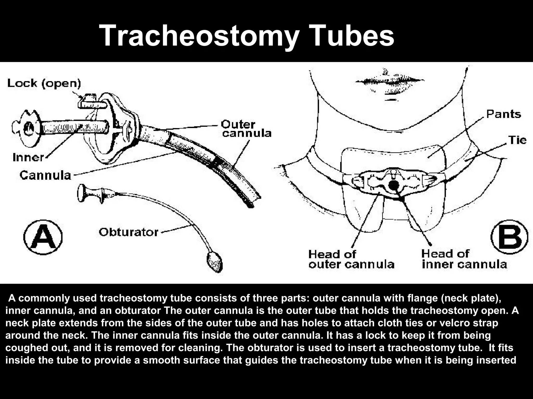 Tracheostomy | PPT