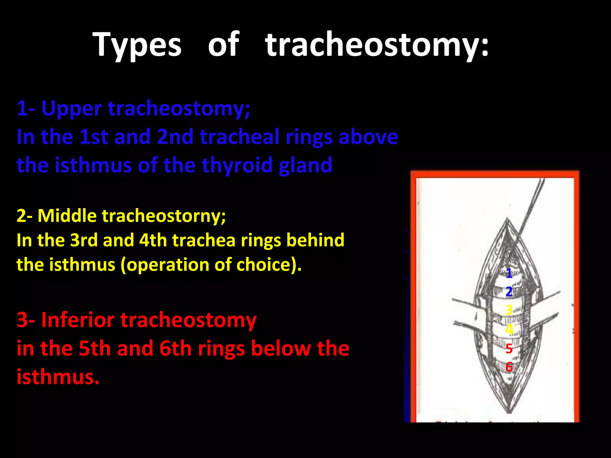 Tracheostomy | PPT