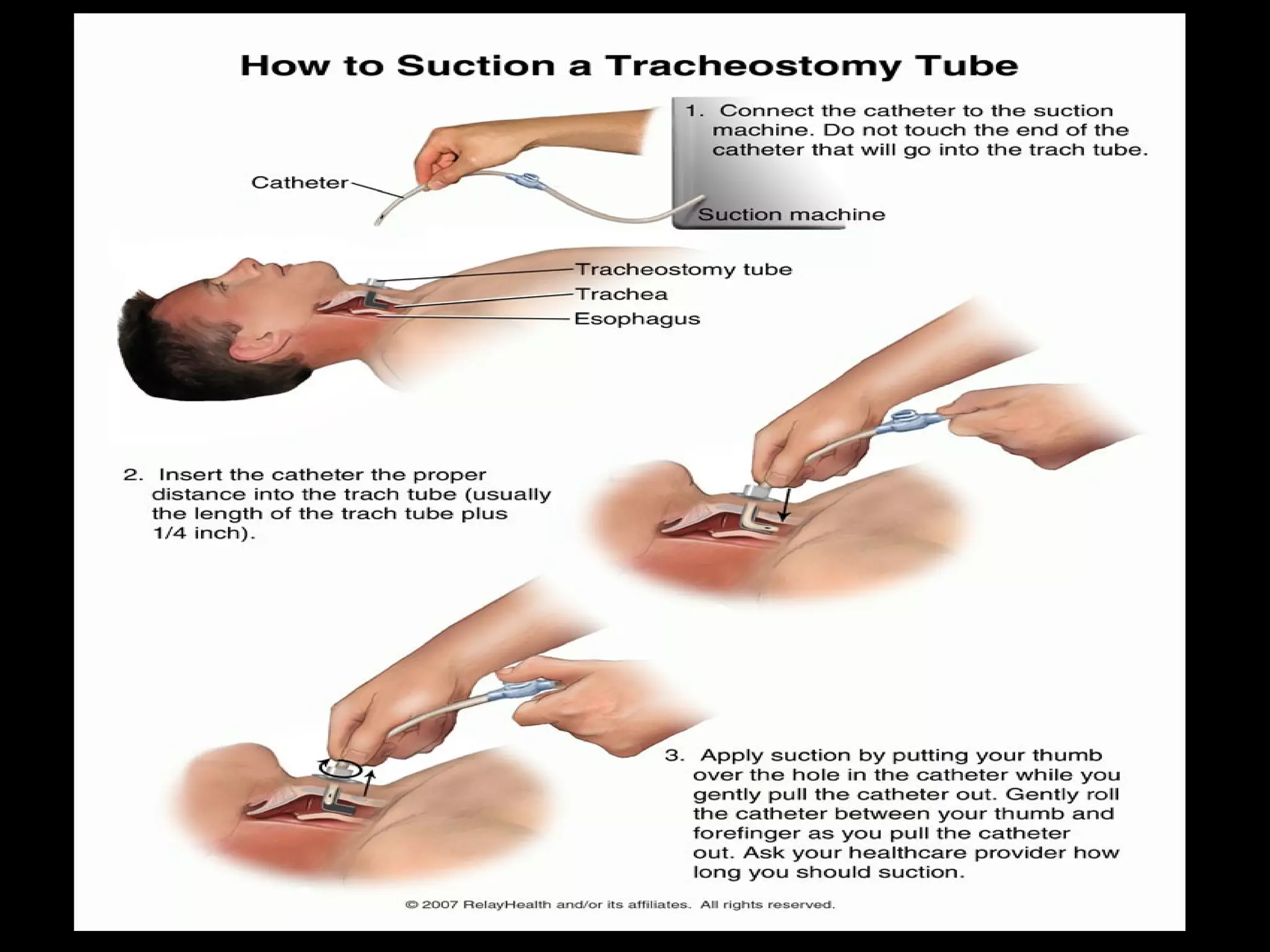 Tracheostomy | PPT