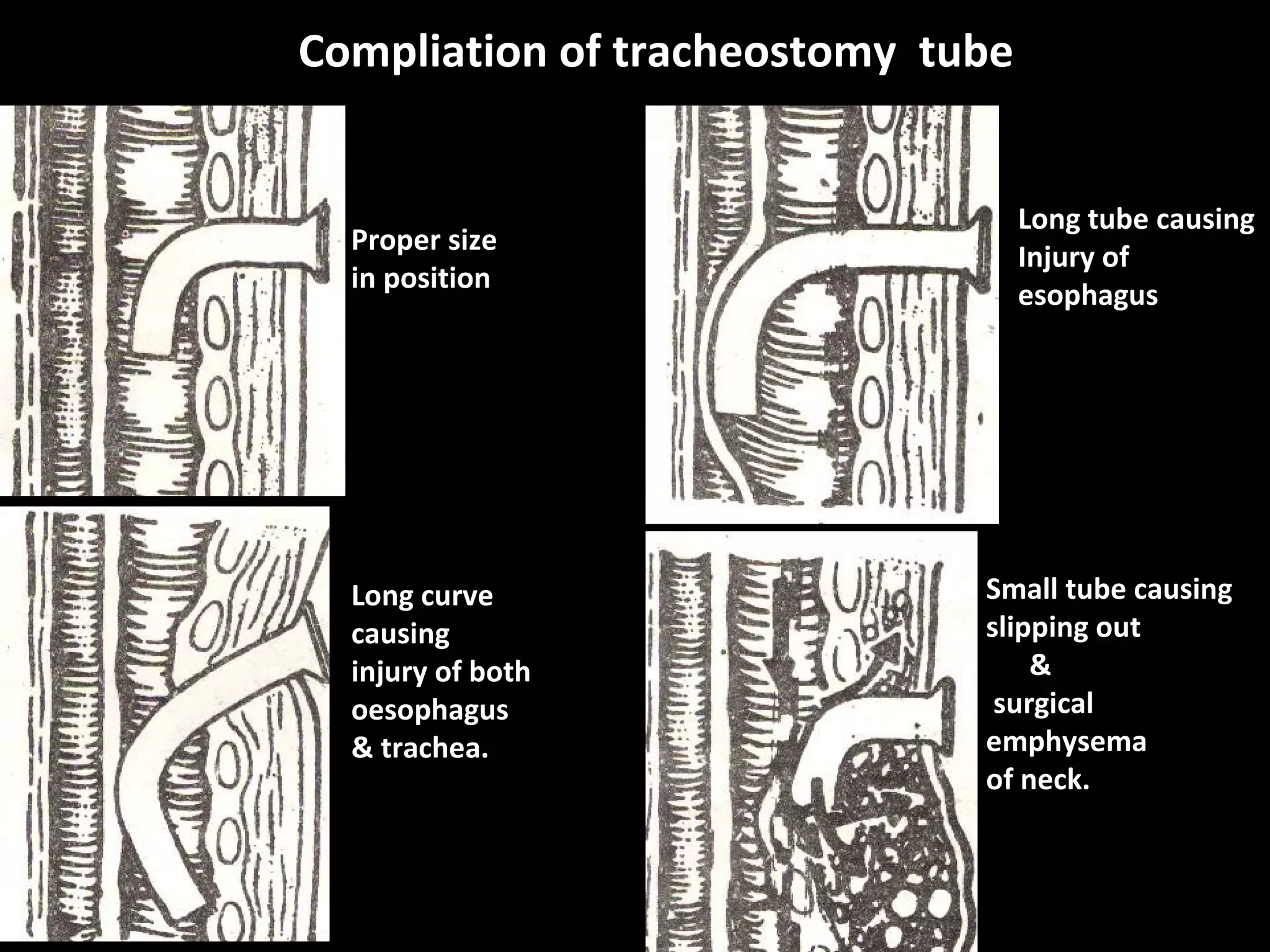 Tracheostomy | PPT